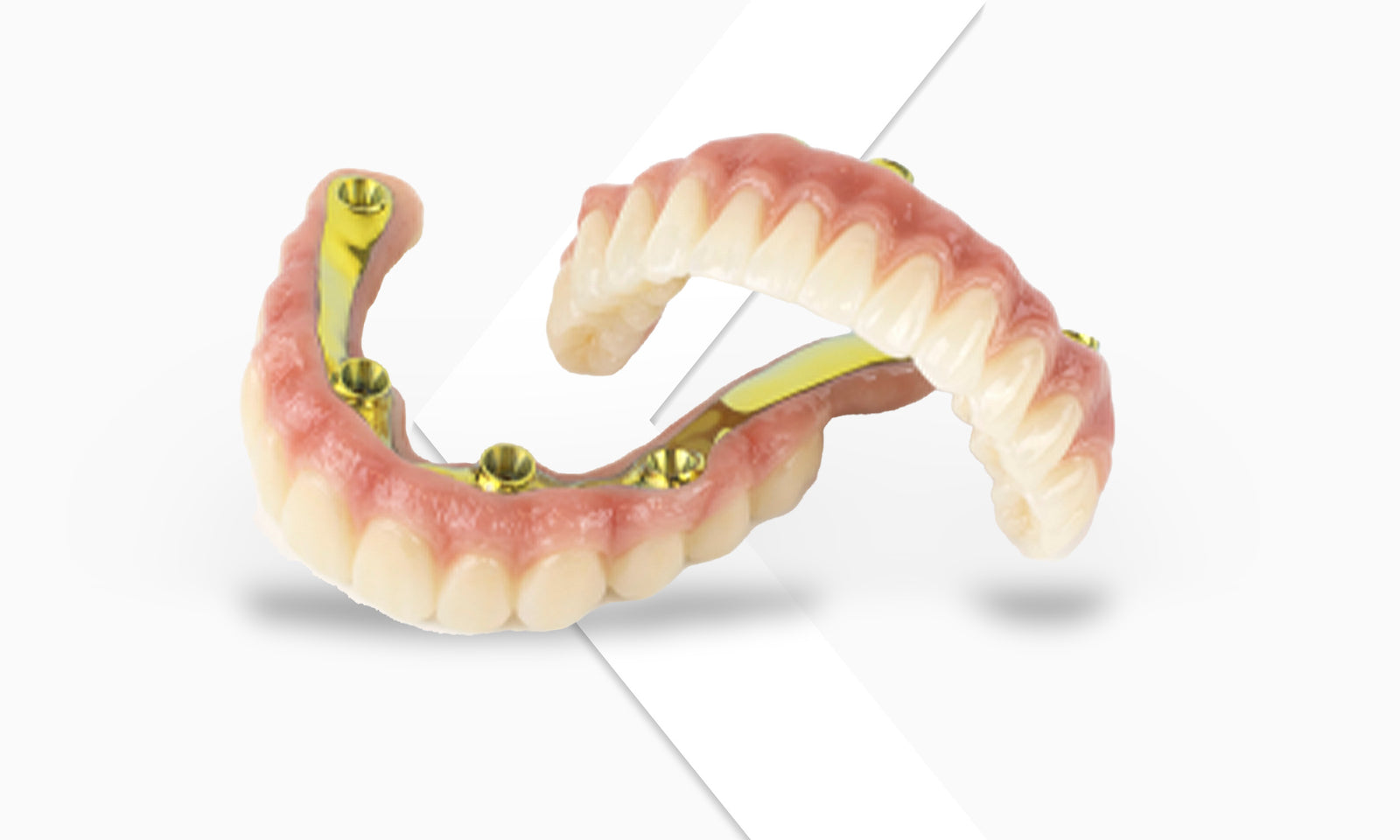 Digital Implant Workflow – Keystone Dental Group