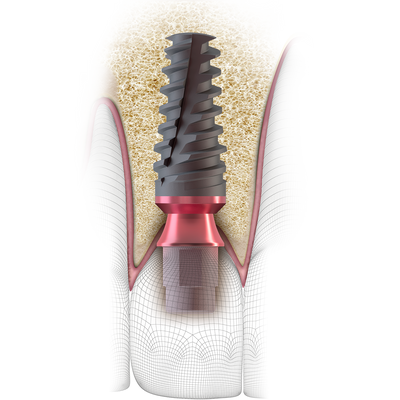 Genesis Active Conical Implant System – Keystone Dental Group